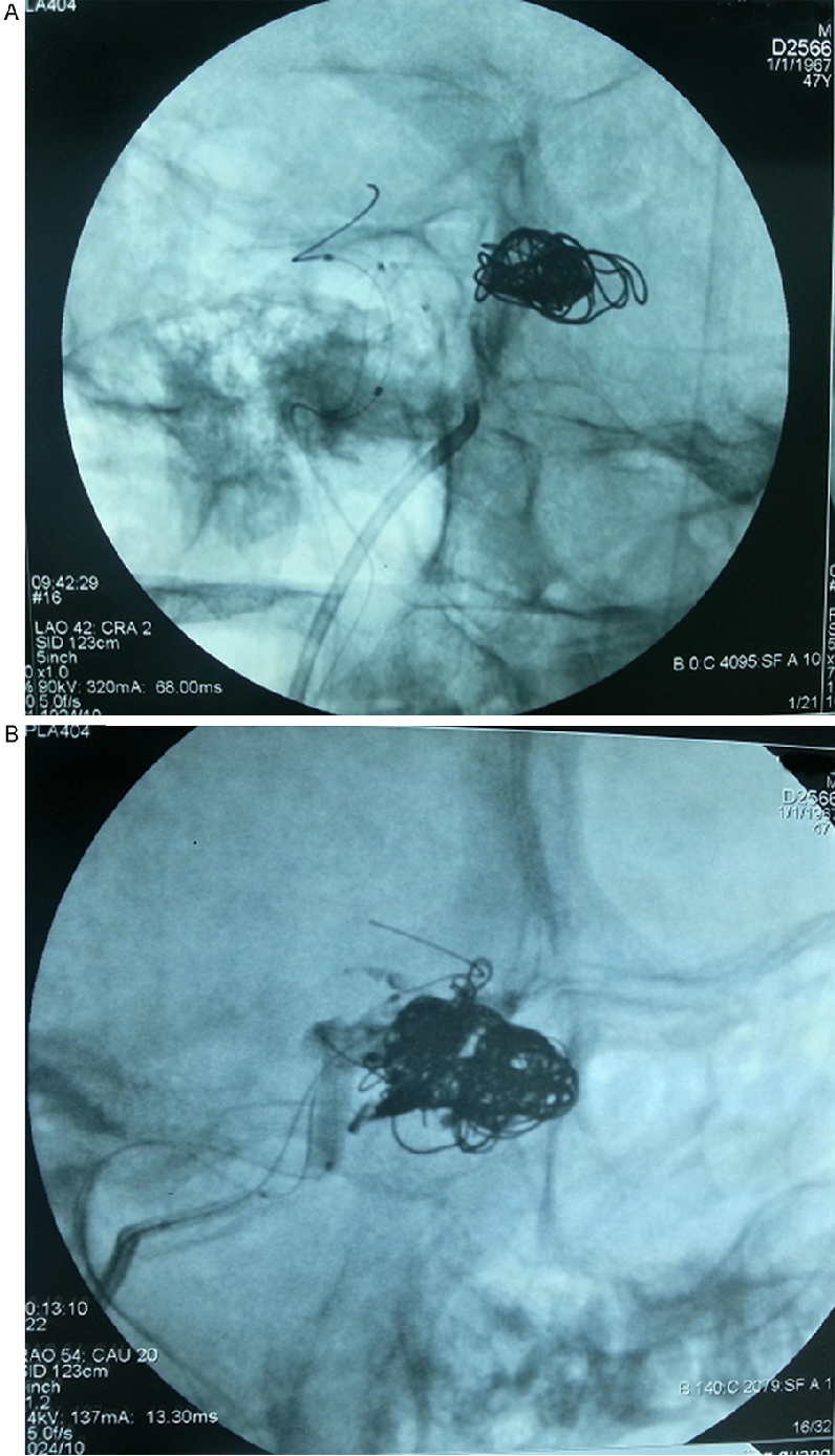 Figure 1 From A Retrospective Analysis Of 38 Carotid Cavernous Fistula