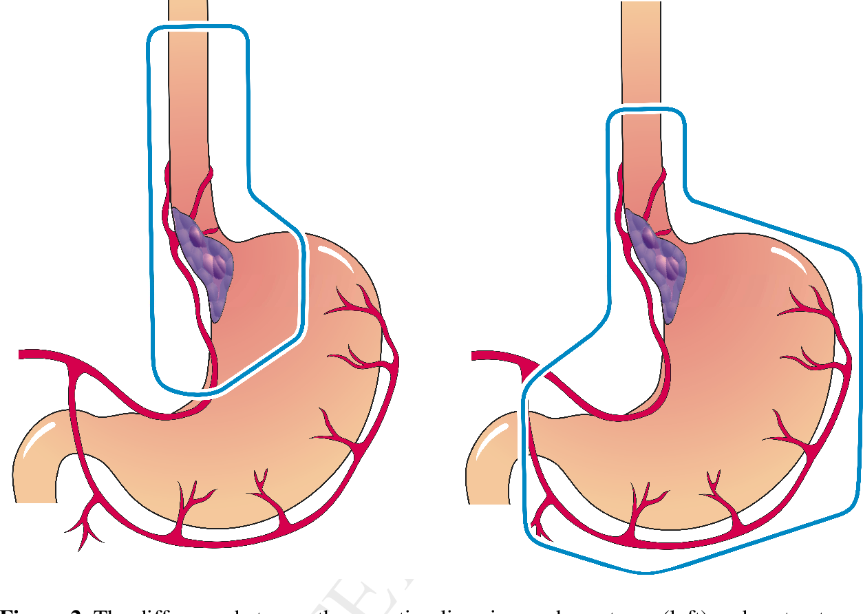 Figure 1 From The Surgical Management Of Esophago Gastric Junctional