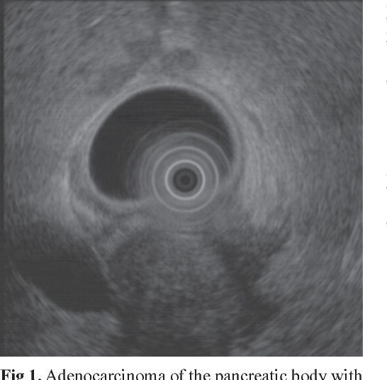 Pdf Radial Endoscopic Ultrasonography In The Preoperative Staging Of