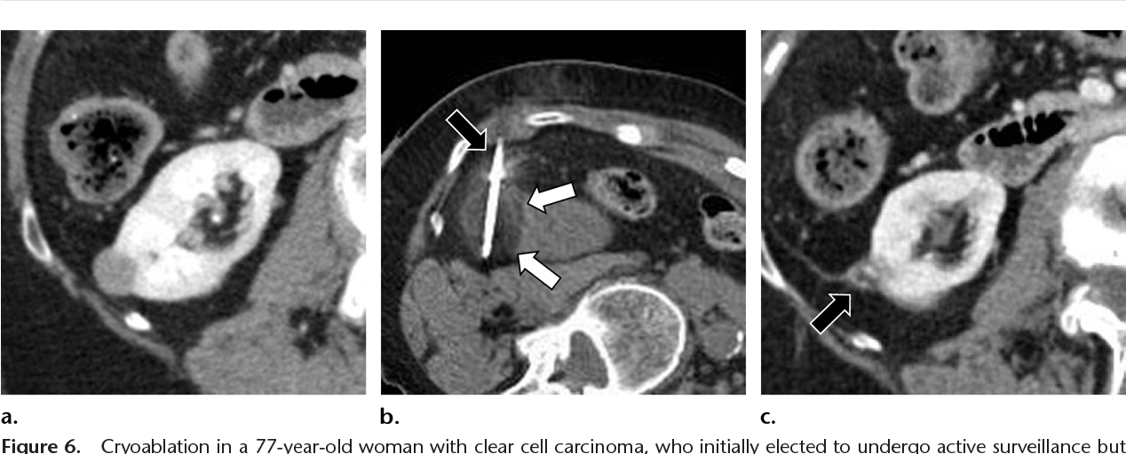 2017 Aua Renal Mass And Localized Renal Cancer Guidelines Imaging