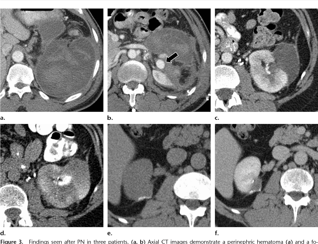 Figure 4 From 2017 Aua Renal Mass And Localized Renal Cancer Guidelines