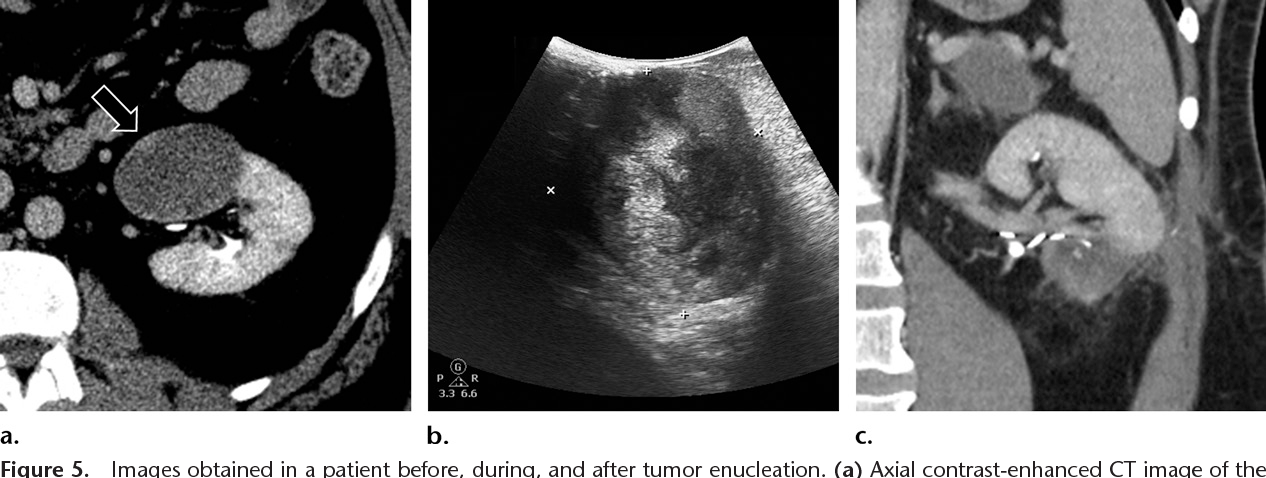 Figure 4 From 2017 Aua Renal Mass And Localized Renal Cancer Guidelines