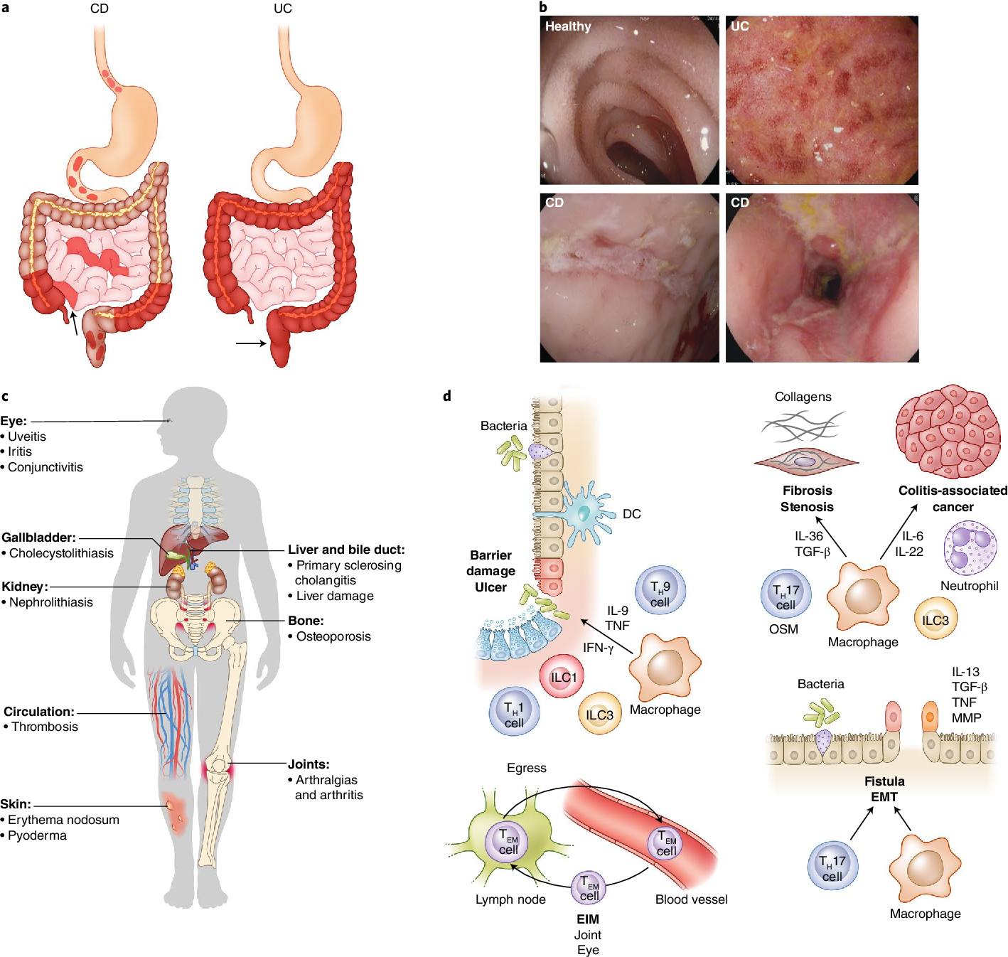 Irritable Bowel Disease