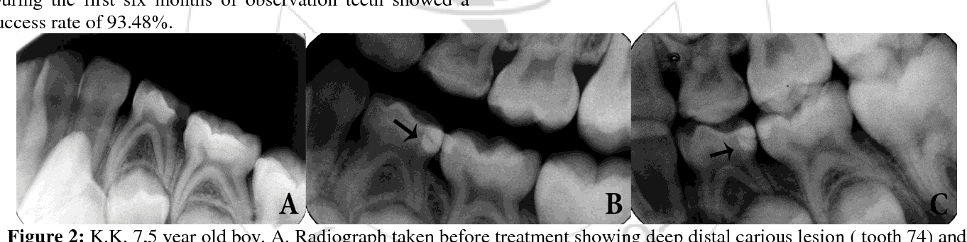 Pdf Success Of Direct Pulp Capping And Partial Pulpotomy Of Primary