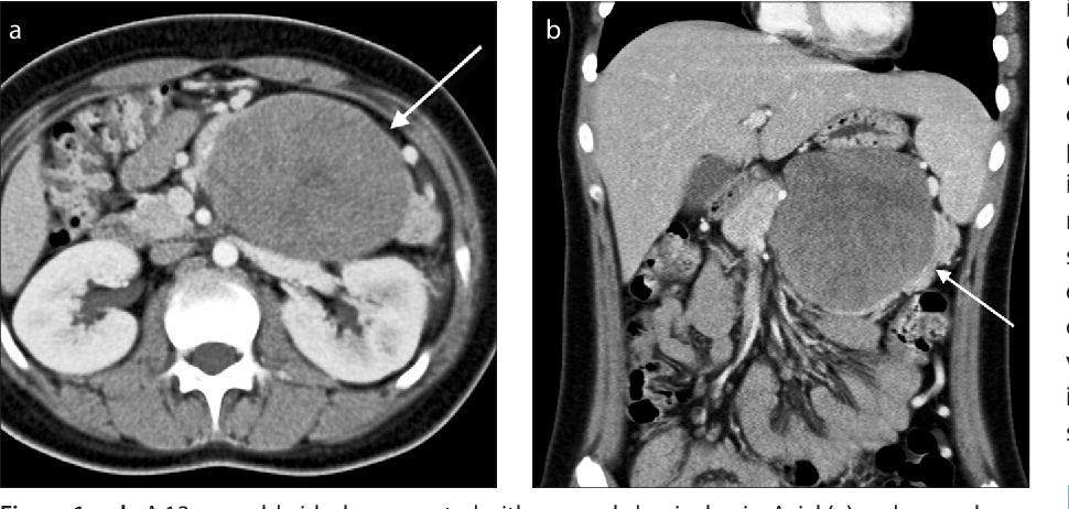 Table 1 From Solid Pseudopapillary Neoplasm Of The Pancreas Ct Imaging