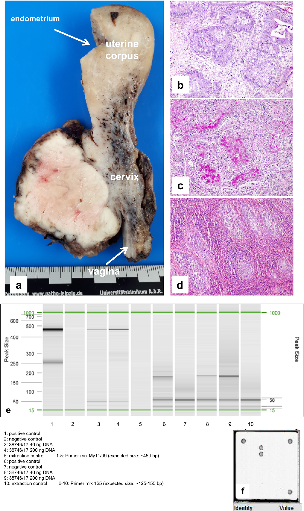 Invasive Stratified Mucin Producing Carcinoma I Smile Of The Uterine