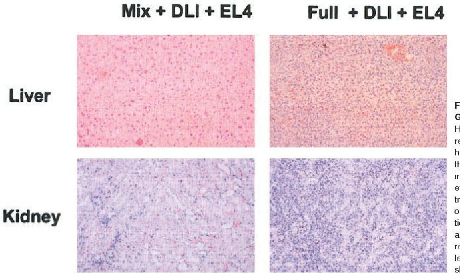 Graft Vs Leukemia Effect Semantic Scholar