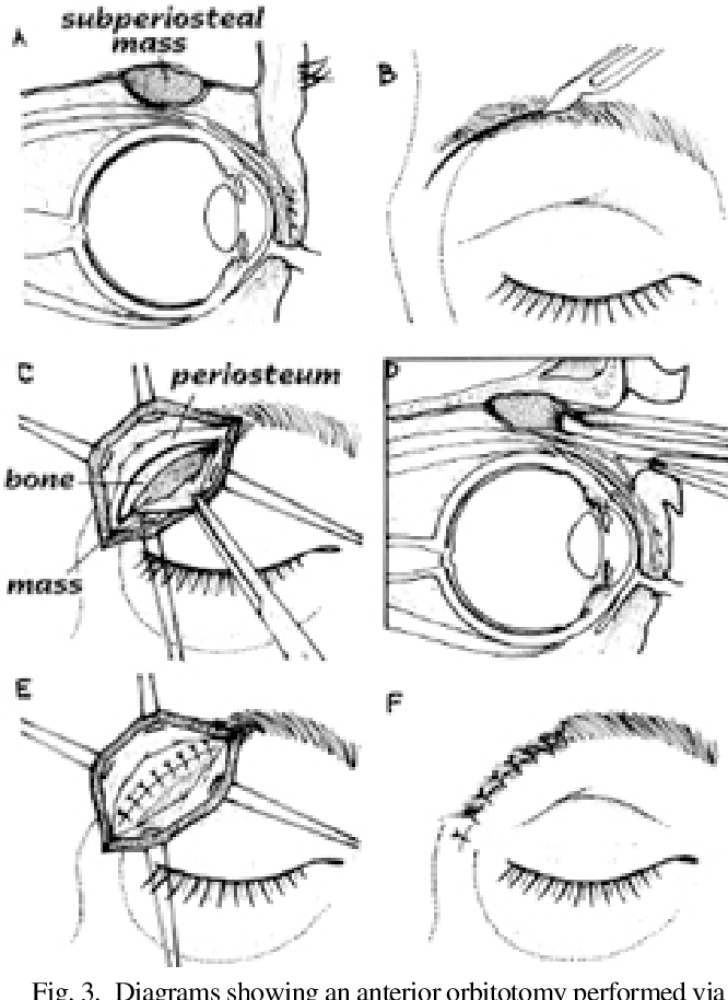 Figure 7 From Surgery For Orbital Tumors Part Ii Transorbital