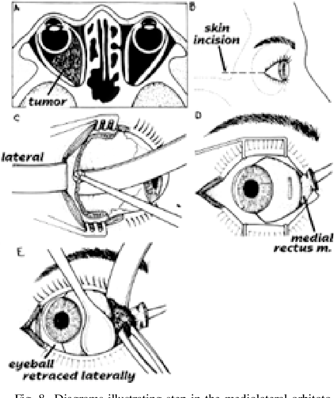 Figure 3 From Surgery For Orbital Tumors Part Ii Transorbital