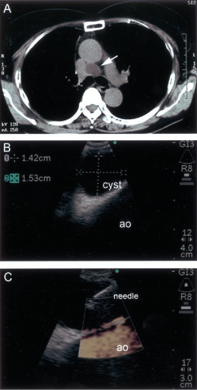 Figure 1 From Real Time Endobronchial Ultrasound Guided Transbronchial