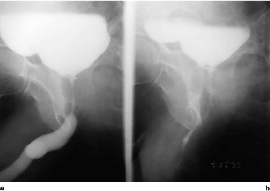 Figure 2 From Abdominoperineal Repair Of Recurrent And Complex Bladder