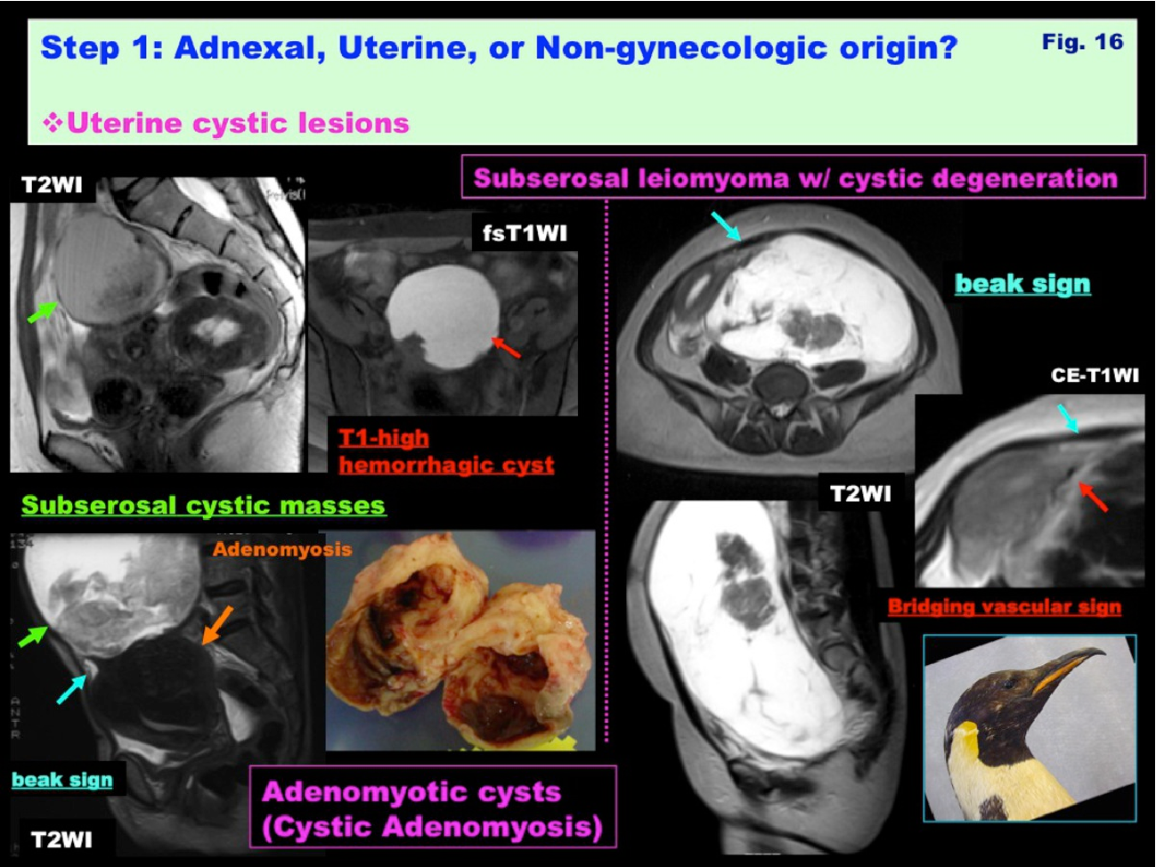 Differential Diagnosis Of Cystic Masses In The Female Pelvis Based On