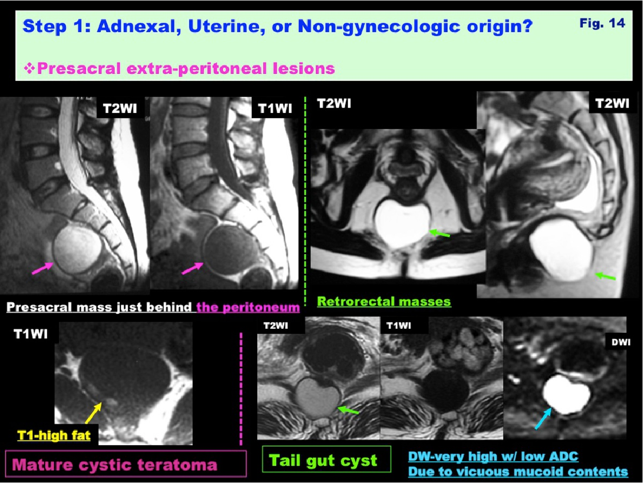 Differential Diagnosis Of Cystic Masses In The Female Pelvis Based On