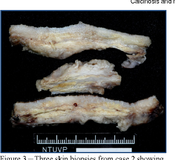 Figure 1 From Calcinosis Cutis Calcinosis Circumscripta And “ Mille