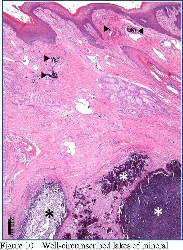 Figure 2 From Calcinosis Cutis Calcinosis Circumscripta And “ Mille