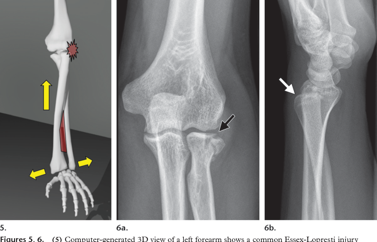 Figure 2 From Traumatic Elbow Injuries What The Orthopedic Surgeon