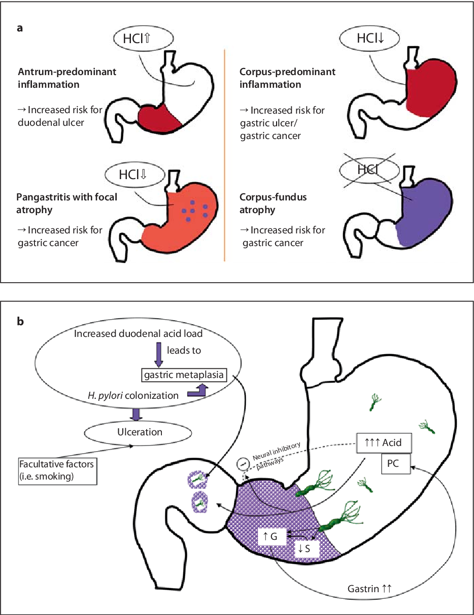 The Intriguing Relationship Of Helicobacter Pylori Infection And Acid