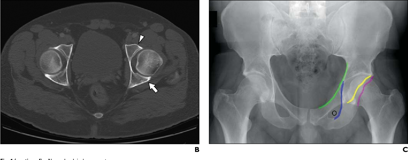 Figure 1 From Classification Of Common Acetabular Fractures