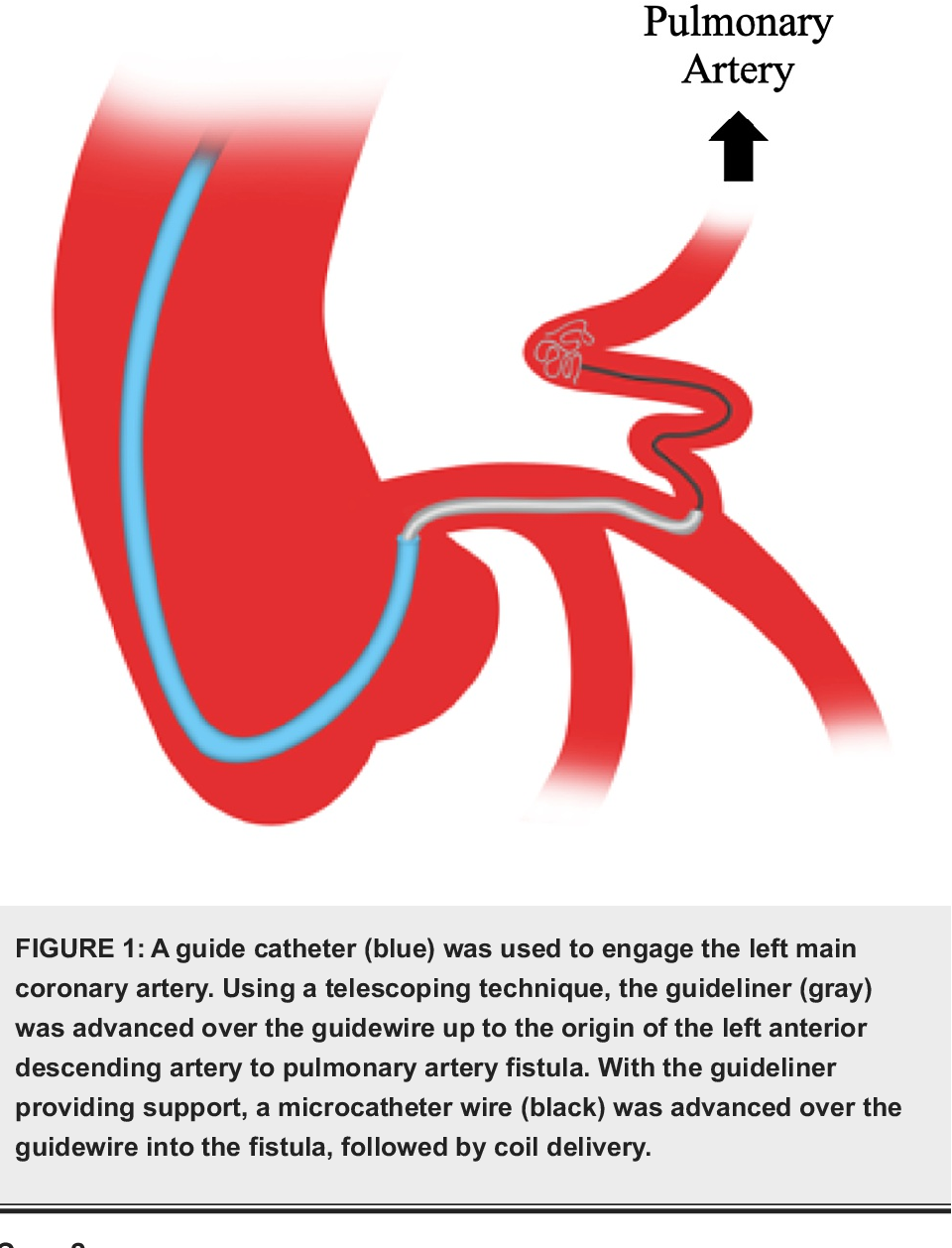 Figure 1 From Coronary Pulmonary Artery Fistula Repair With Coil