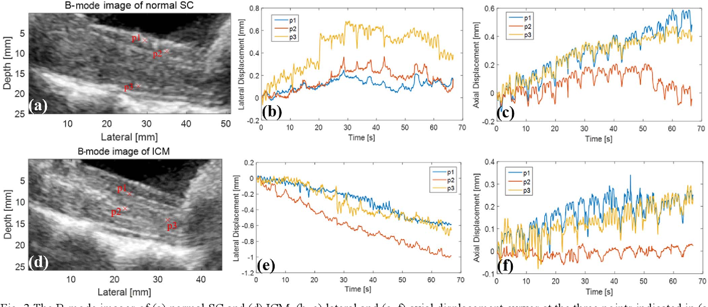 Figure 3 From Intraoperative Ultrasound Localization Microscopy Of