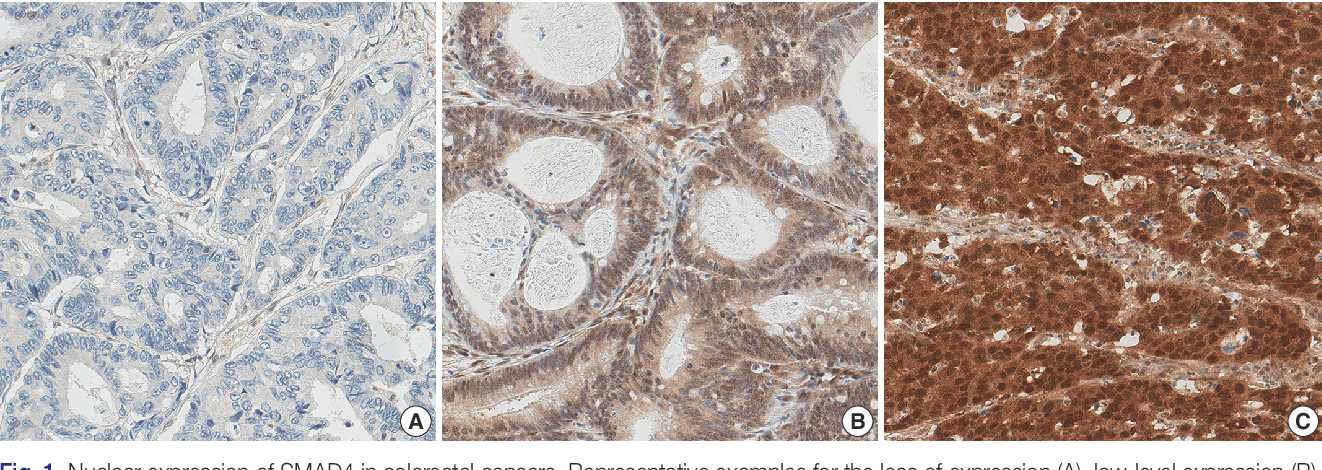 Figure 1 From Clinicopathological Characterization And Prognostic