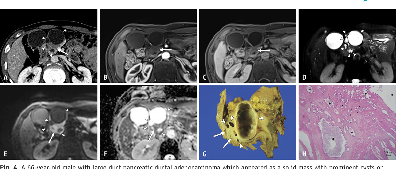 Figure 1 From Large Duct Pancreatic Ductal Adenocarcinoma A