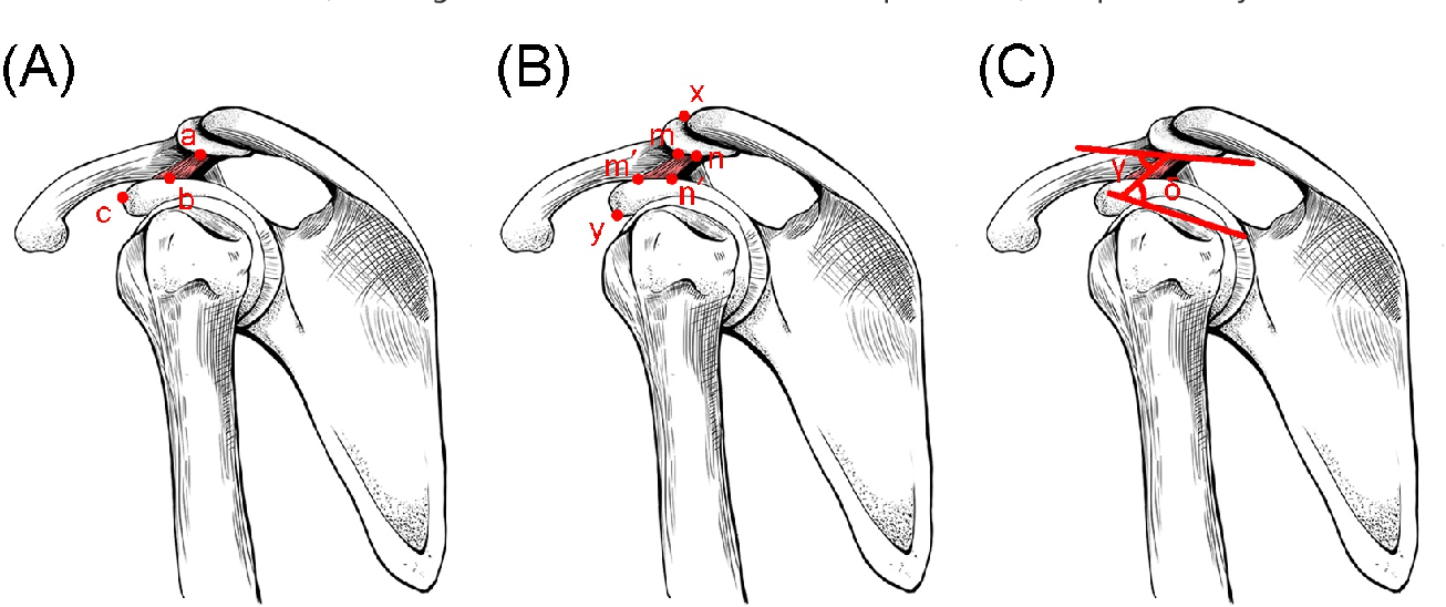 Pdf Anatomical Parameters Of The Coracoclavicular Ligament A Study