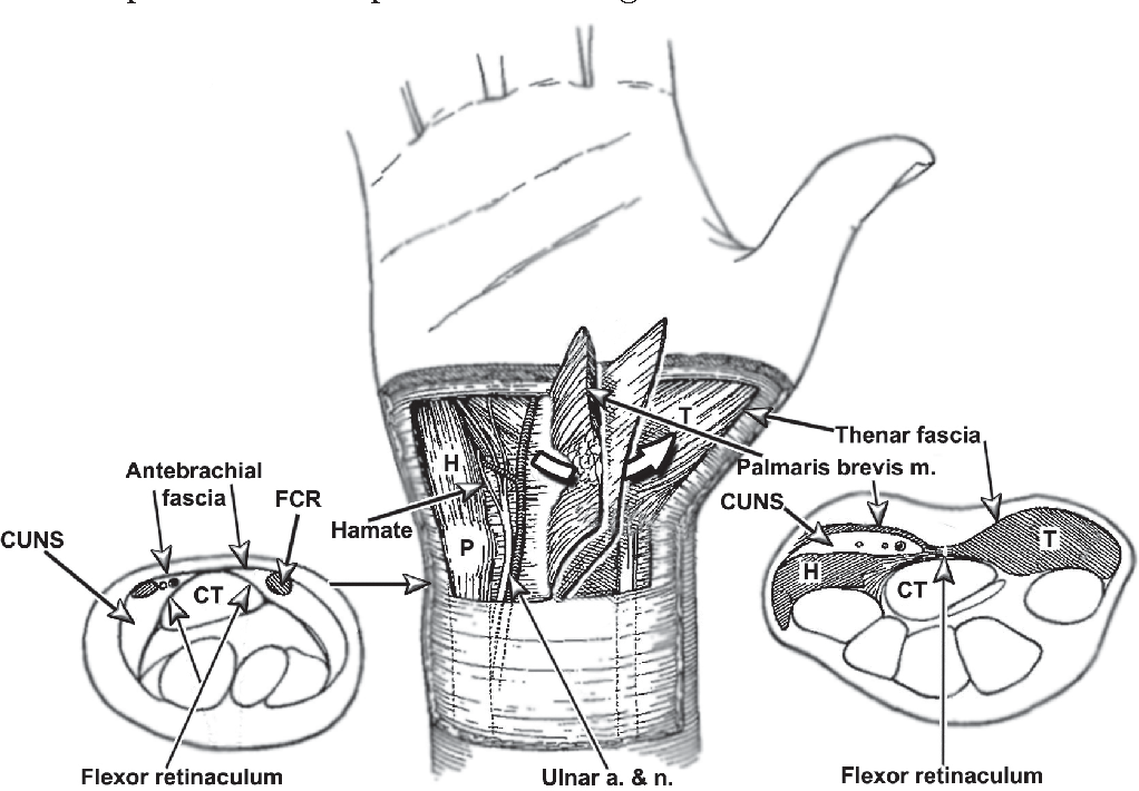 Figure 4 From Topography Of Ulnar Nerve And Its Variations With Special