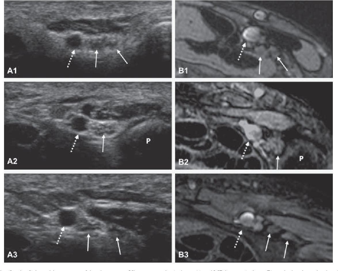 Variations Of The Ulnar Nerve In Guyons Canal In Vivo Demonstration