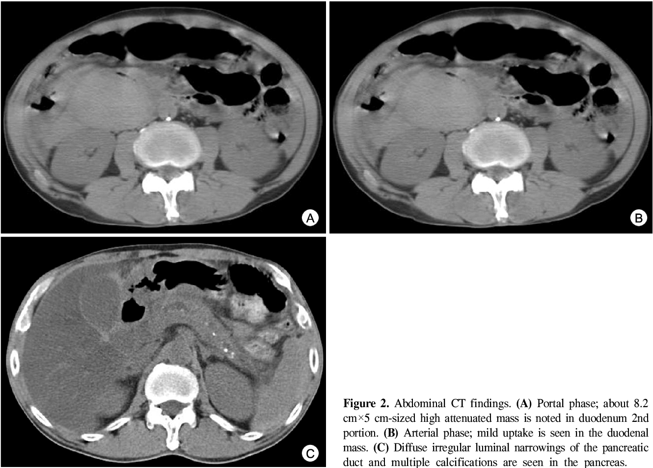 Figure 1 From A Case Of Duodenal Intramural Hematoma Complicated With