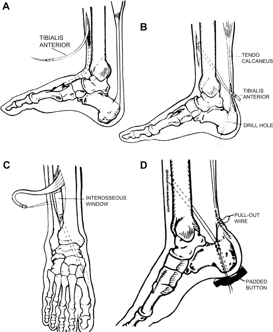 Tendon Transfer