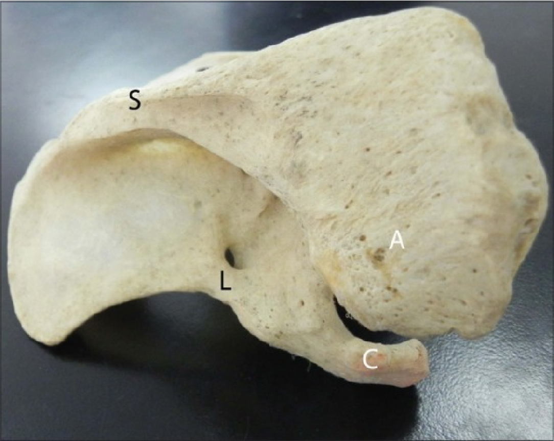 Figure 3 From Ossification Of The Suprascapular Ligament A Risk Factor