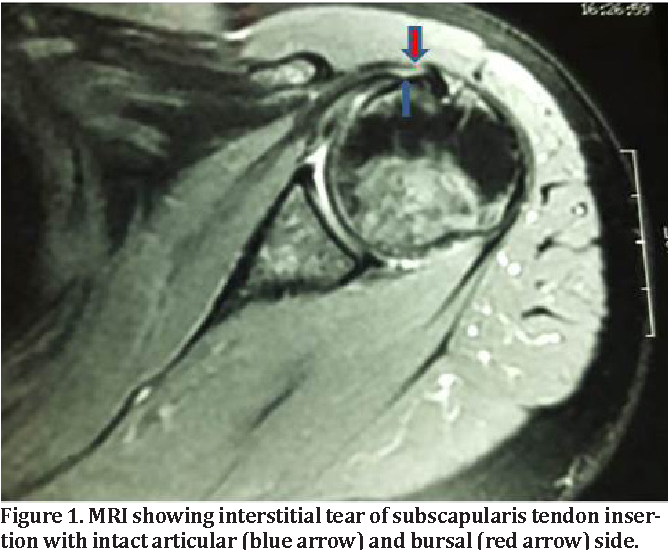 Pdf Interstitial Tear Of The Subscapularis Tendon Arthroscopic