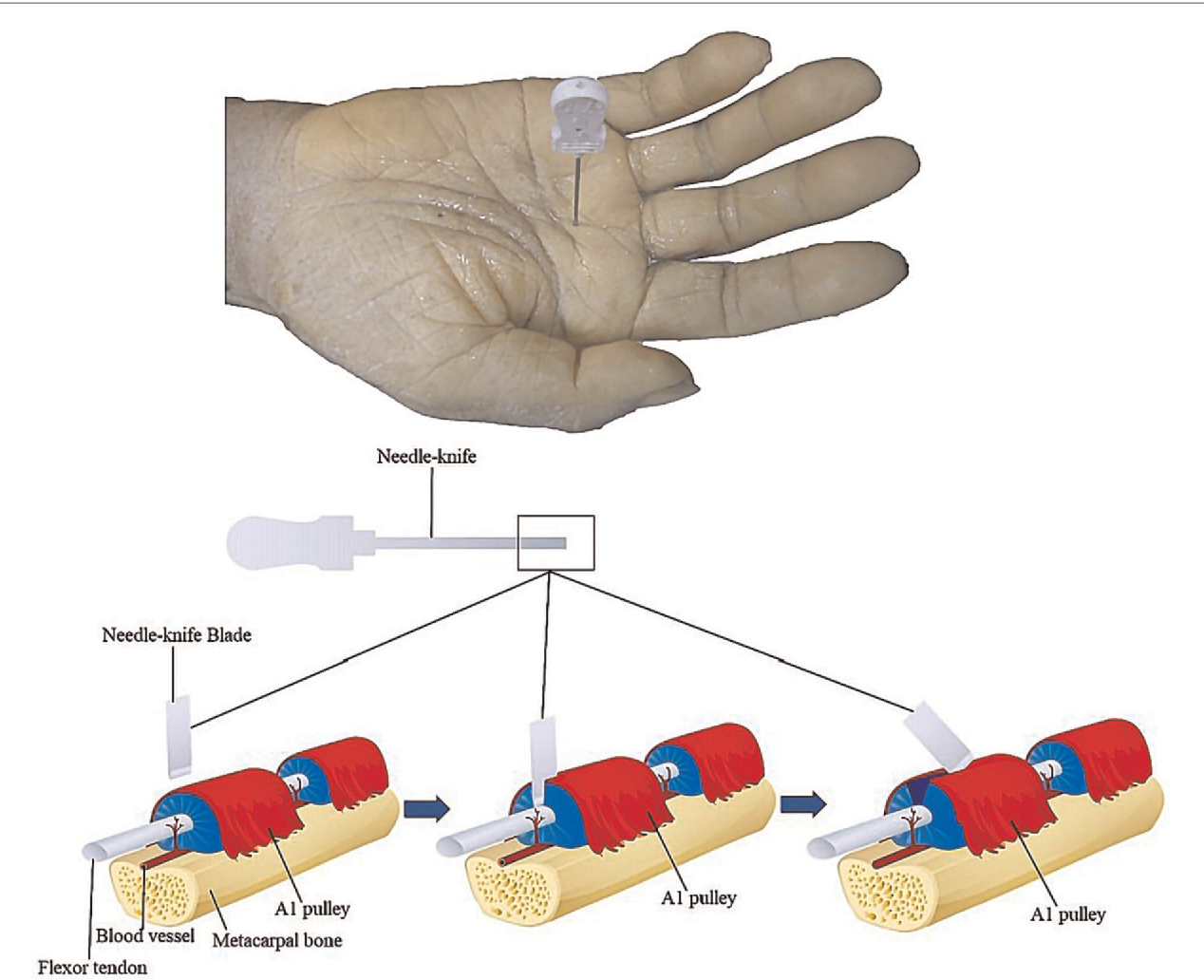 Figure 1 From Safety And Efficacy Of Ultrasound Guided Percutaneous A1