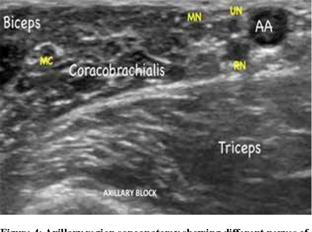 Ultrasound Guided Brachial Plexus Block Semantic Scholar