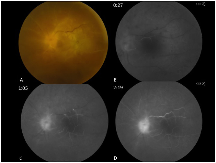 Figure 1 From Bilateral Central Retinal Artery Occlusion Associated