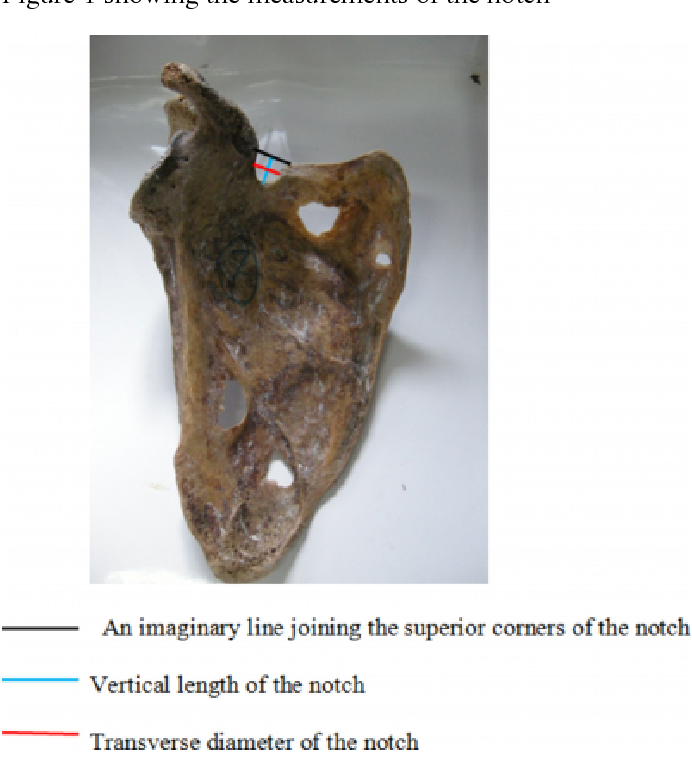 Figure 1 From Morphometric Analysis Of The Suprascapular Notch