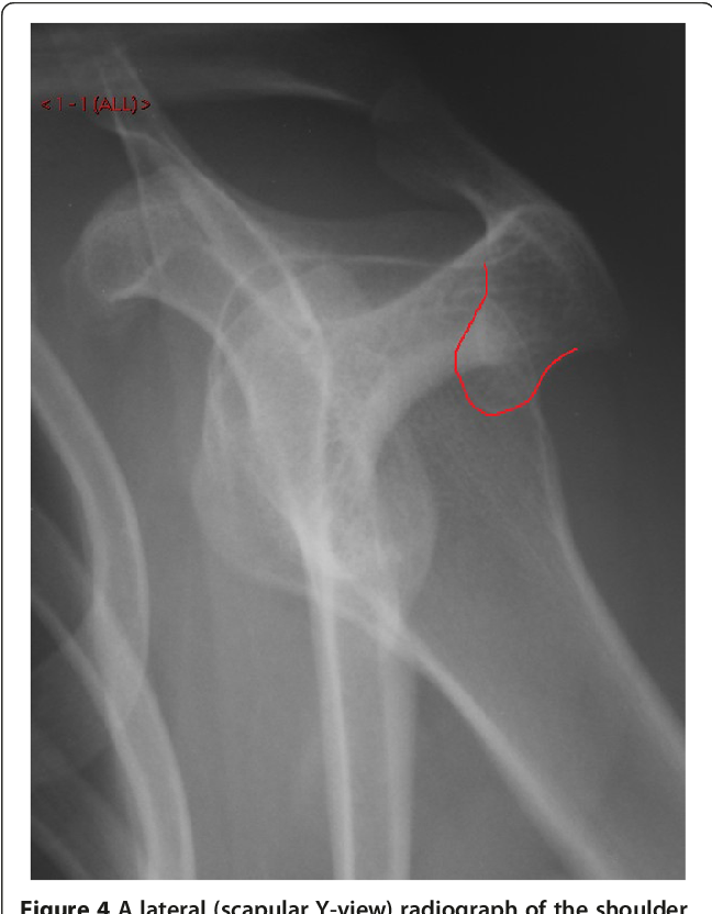 Figure 6 From Subacromial Impingement Syndrome In A Patient With