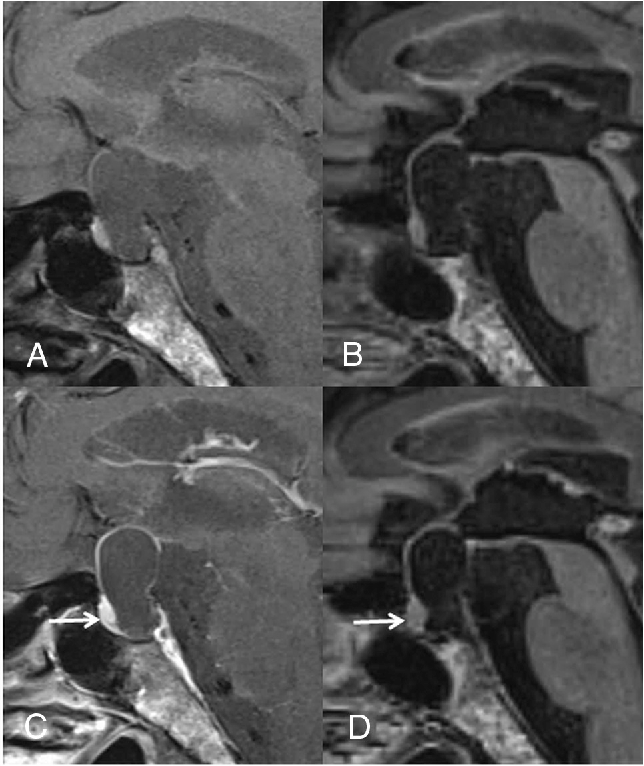 Figure 1 From Usefulness Of Contrast Enhanced 3d Flair Mr Imaging For