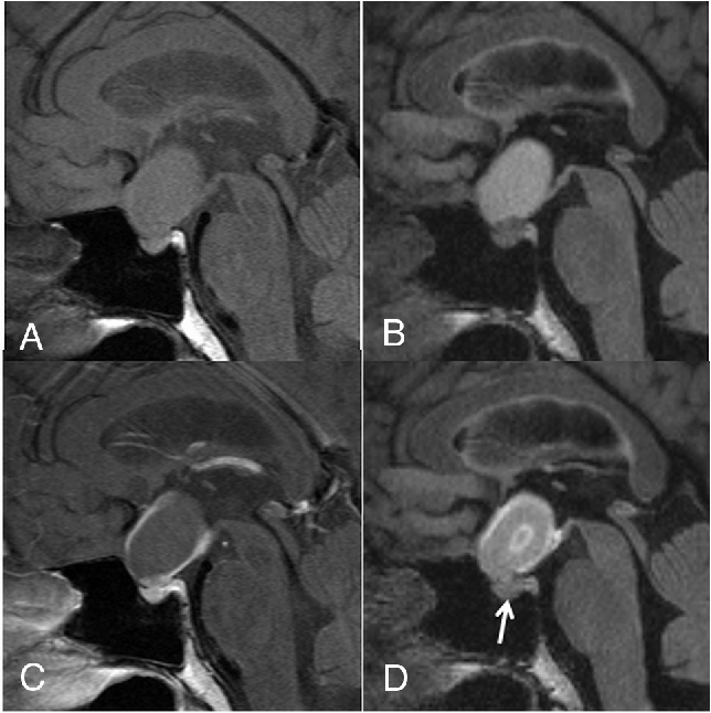 Figure 1 From Usefulness Of Contrast Enhanced 3d Flair Mr Imaging For