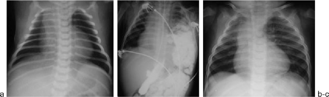 Figure 1 From Late Presentation Of Congenital Diaphragmatic Hernia