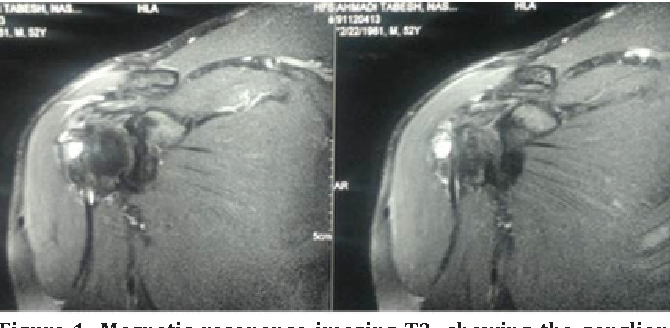 Intra Articular Ganglion Cyst Of The Long Head Of The Biceps Tendon