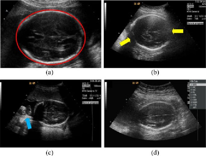 Automatic Fetal Head Circumference Measurement In Ultrasound Using