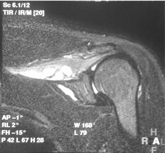 Figure 1 From Arthroscopic Decompression Of Paralabral Cyst Around