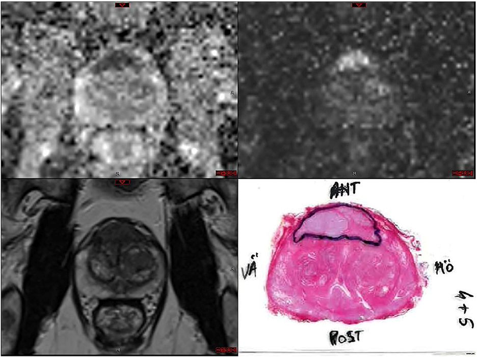 Figure 2 From Bi Parametric Mritrus Fusion Targeted Repeat Biopsy