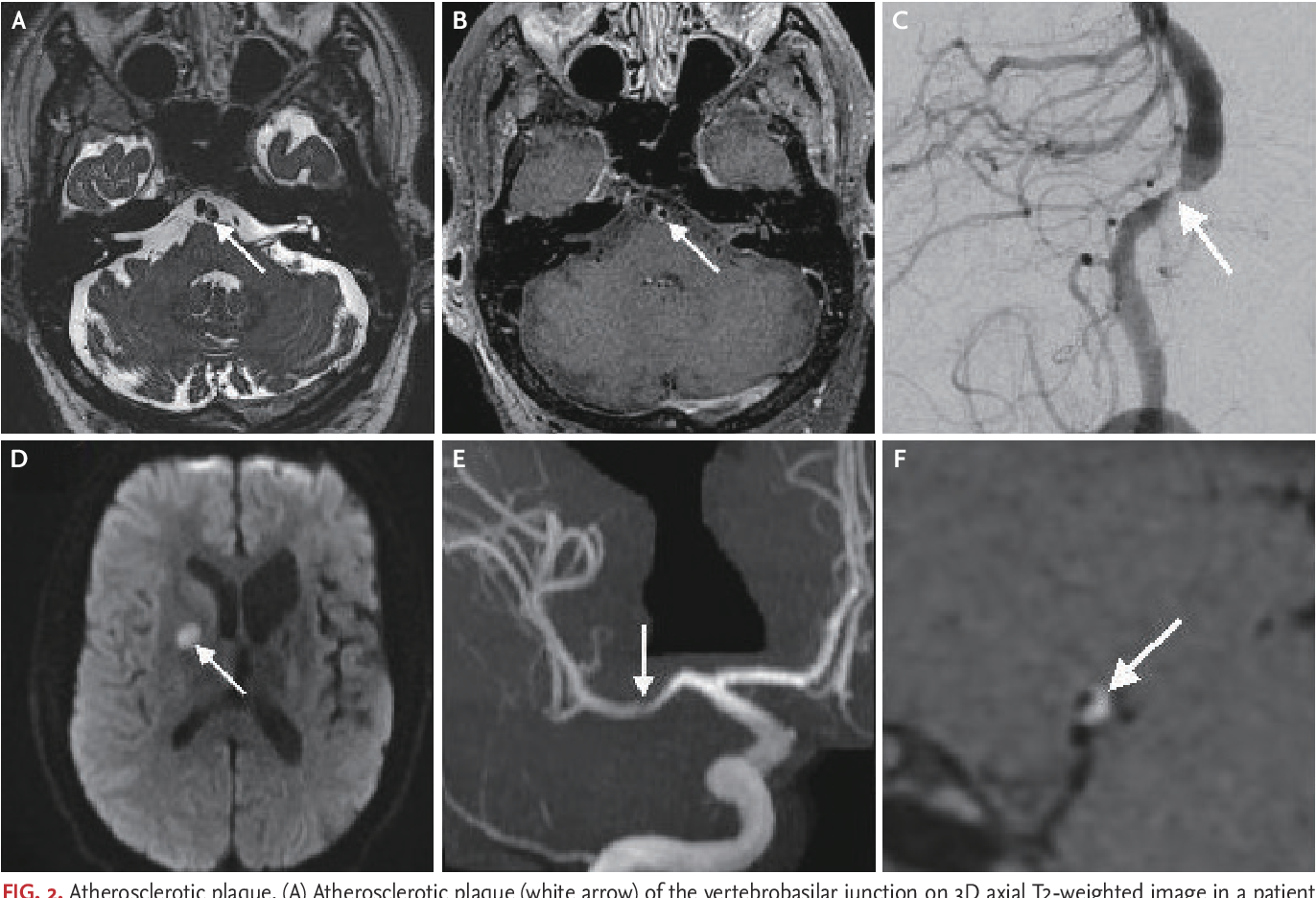 Figure 2 From Application Of Vessel Wall Magnetic Resonance Imaging In