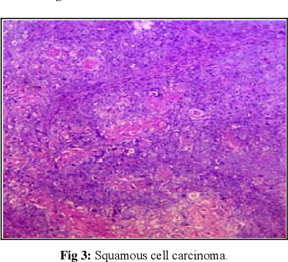 Pdf An Insight Into Non Transitional Cell Carcinoma Of Bladder A Six