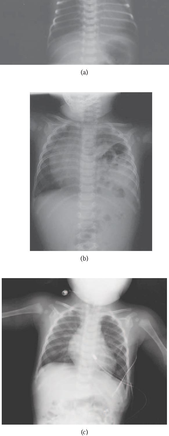 Figure 1 From Acute Respiratory Distress For Late Presenting Congenital