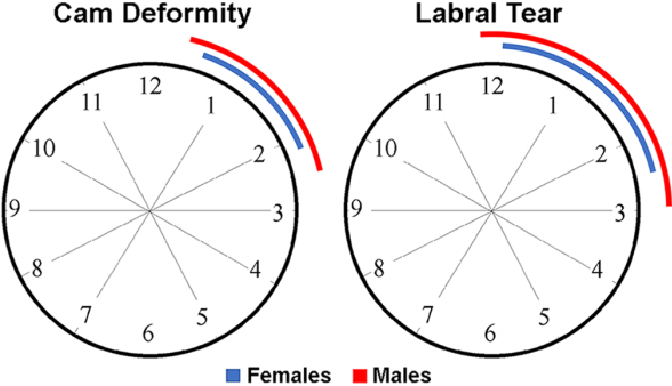 Figure 2 From Sex Based Differences In Femoroacetabular Impingement