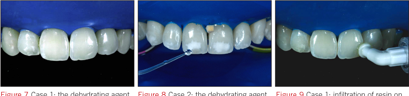 Resin Infiltration In White Spot Lesions Caused By